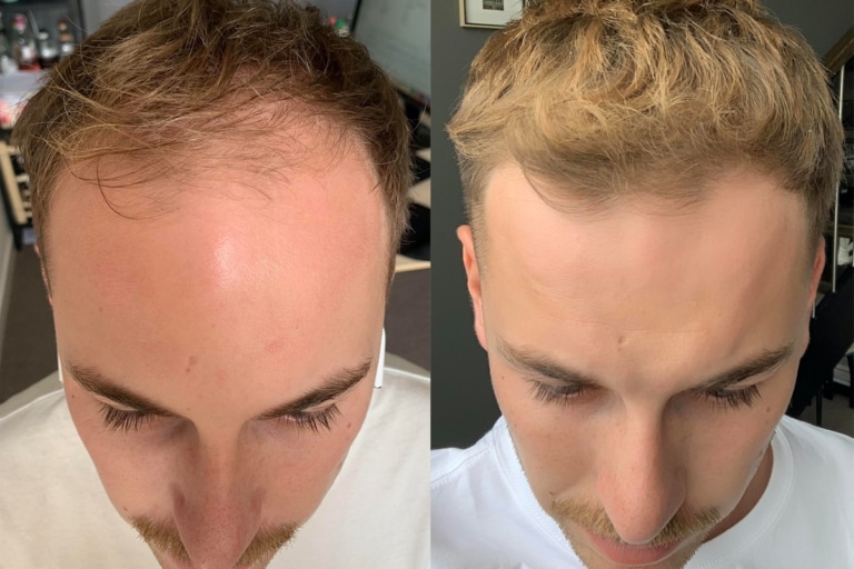 How to Not Be ‘The Hat Guy’ of Hair Loss | Man of Many
